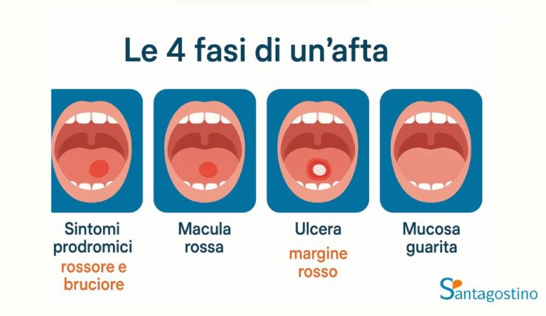 Afte in bocca: cause, sintomi e rimedi efficaci - Santagostino Genova